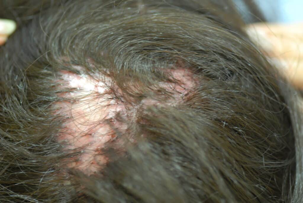 Folliculitis decalvans | derma.plus