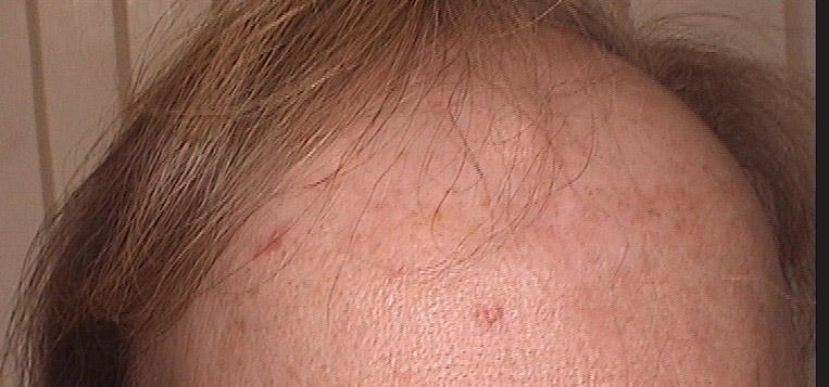 Frontal fibrosierende Alopezie | derma.plus