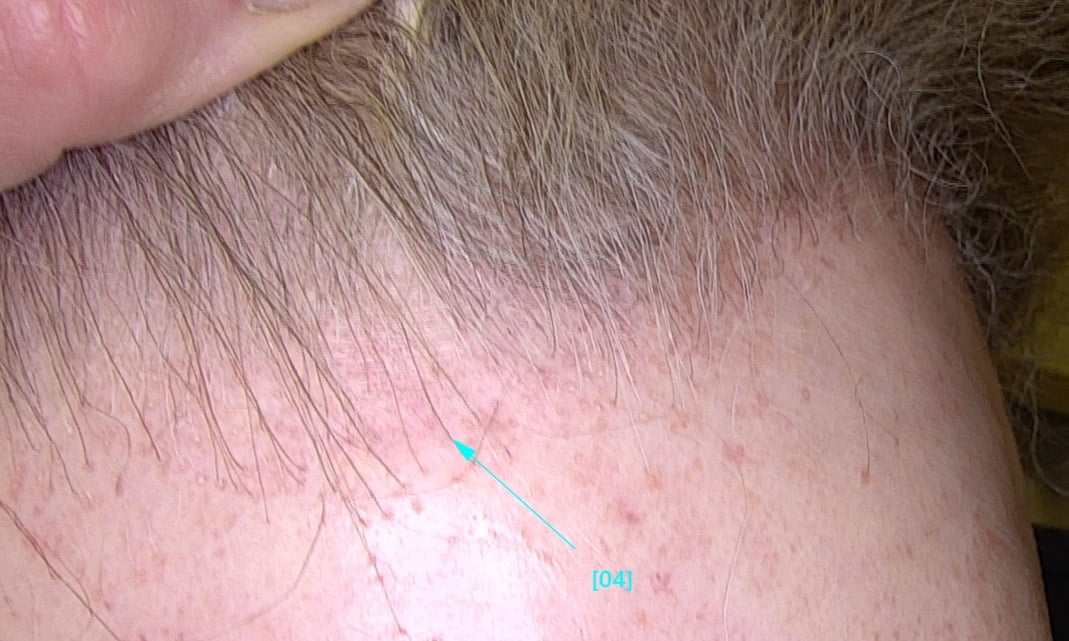 Frontal fibrosierende Alopezie | derma.plus