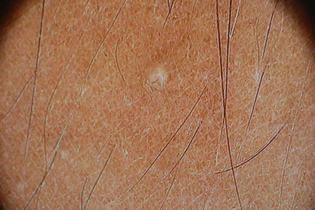 Reibeisenhaut (Keratosis pilaris oder Kertosis follicularis) | derma.plus