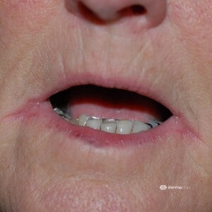 Faulecken (Angulus infectiosus) effektiv behandeln | derma.plus