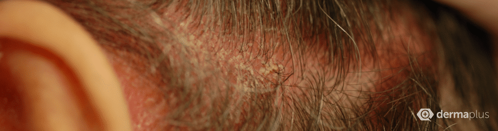 Kopfpsoriasis (Psoriasis capitis) - Ursachen und Therapie | derma.plus