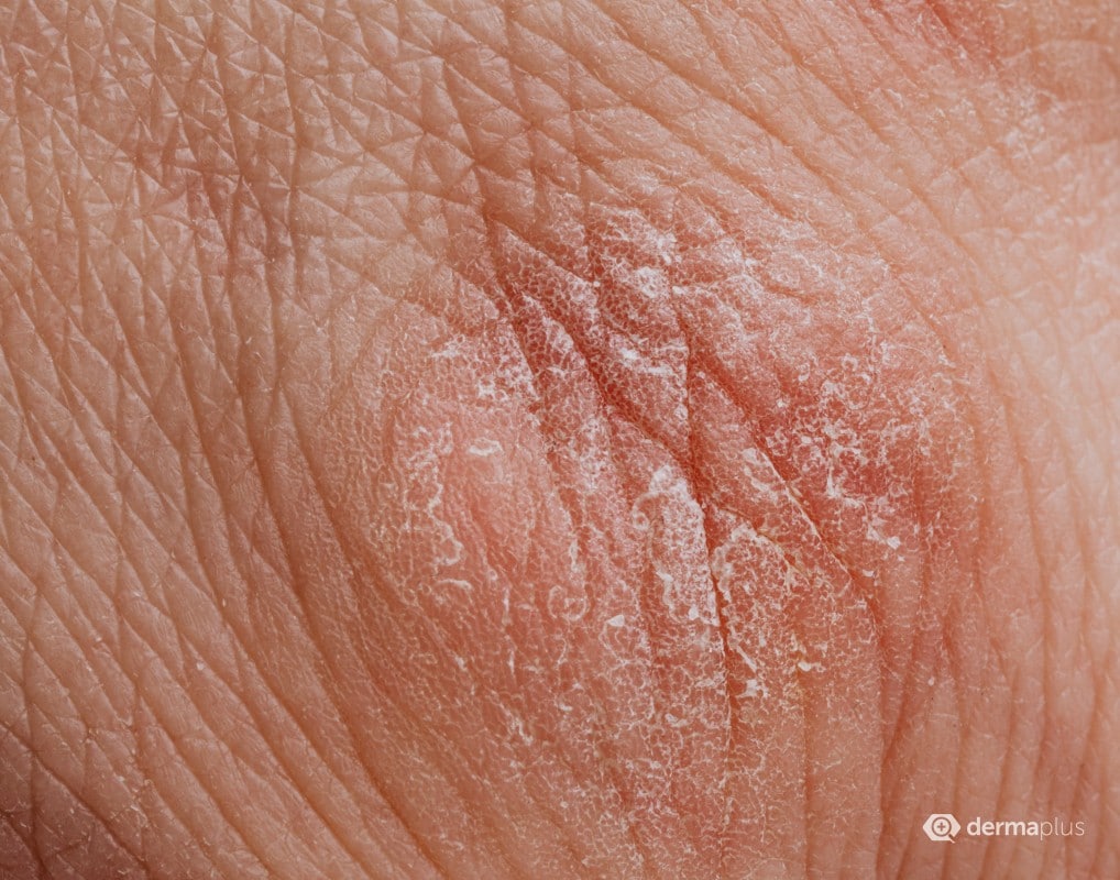 Trockene Haut begünstigt Hautkrankheiten | derma.plus