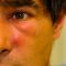 Furunkel (Haarbalgentzündung) effektiv behandeln | derma.plus