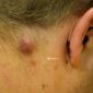 Furunkel (Haarbalgentzündung) effektiv behandeln | derma.plus