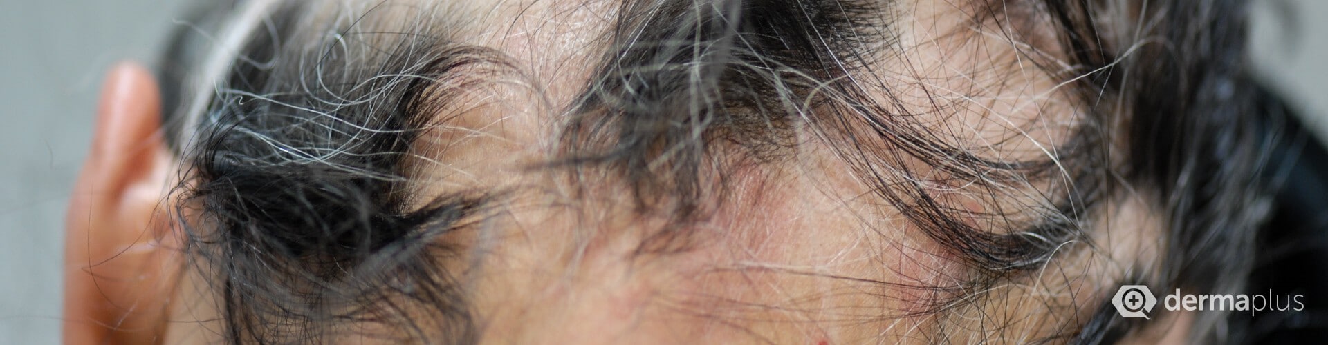 Kreisrunder Haarausfall (Alopecia areata) | derma.plus