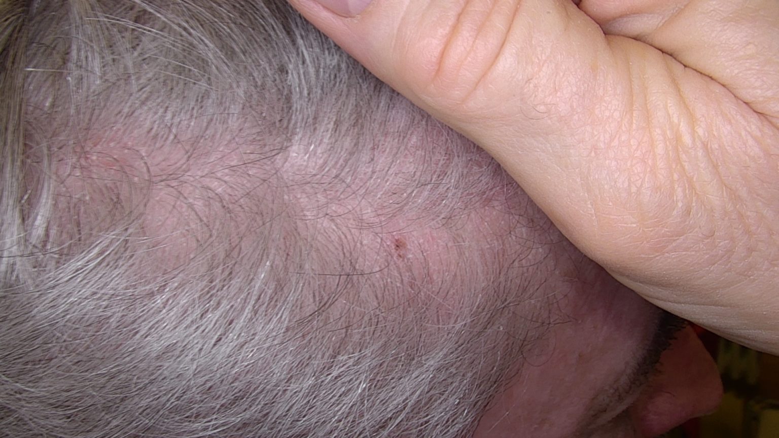 Juckende Kopfhaut: Ursachen und Behandlung | derma.plus