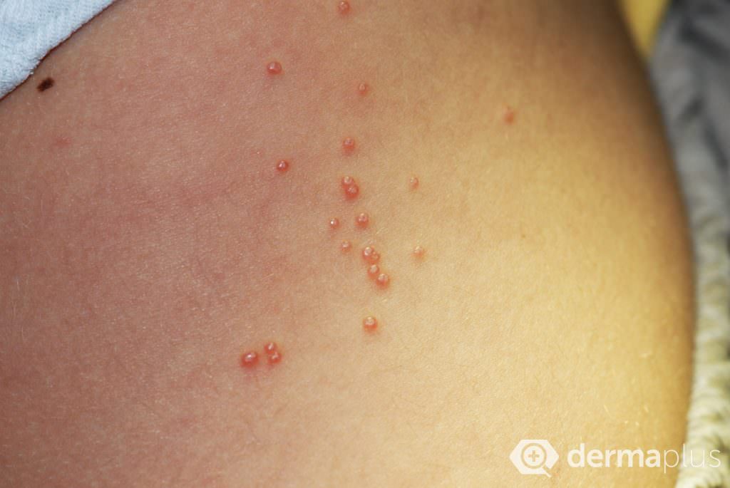 Dellwarzen (Molluscum contagiosum) | derma.plus