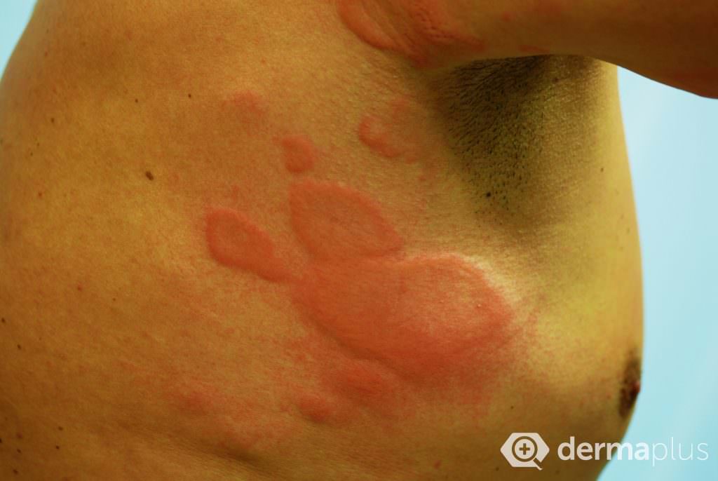 Nesselsucht (Urtikaria) - Ursachen und Therapie | derma.plus