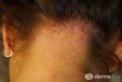 Neurodermitis (Atopisches Ekzem) - Ursachen & Therapie | derma.plus